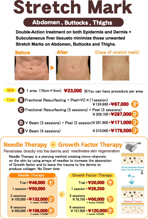 Stretch marks / AZABU SKIN CLINIC